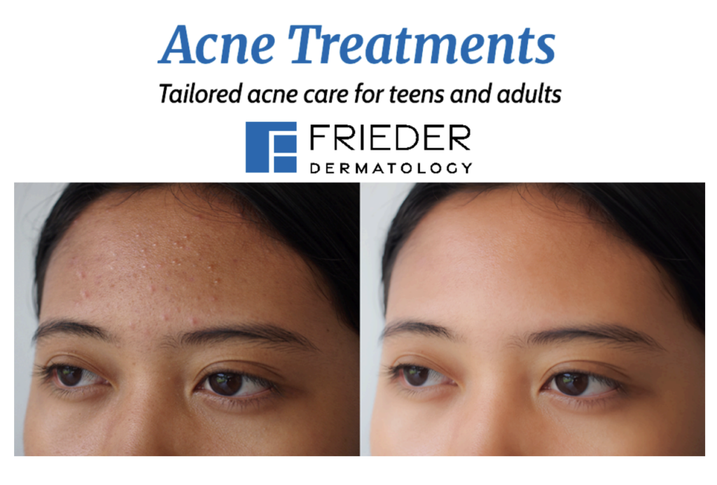 Acne | Acne Treatments | Medical Dermatologist | Boca Raton | Palm ...
